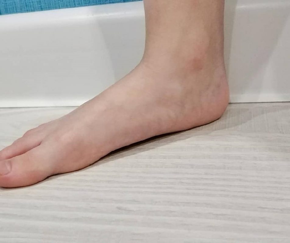 Ploché nohy u dětí - 12 cviků na efektivní tvarování klenby